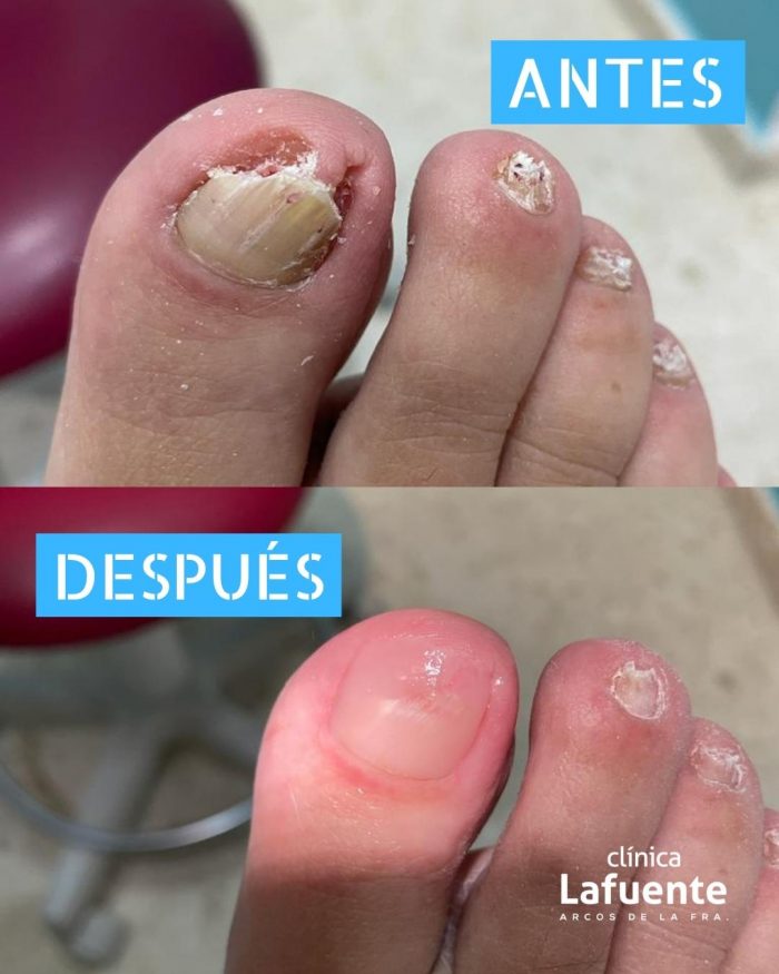 Reconstrucción de uñas. ¿Qué es y en qué casos se usa? - Clínica ...